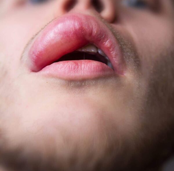 SIMPLE CURE TO SWOLLEN LIPS - Health GadgetsNG