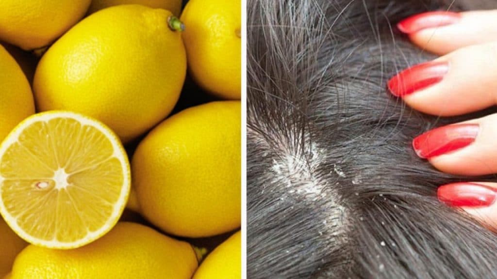 DANDRUFF TREATMENT WITH LEMON - Health GadgetsNG